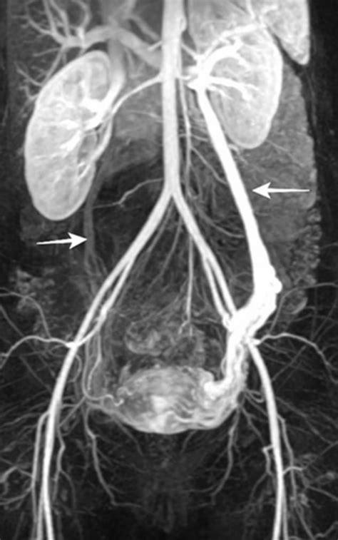 Pelvic Varices Mri