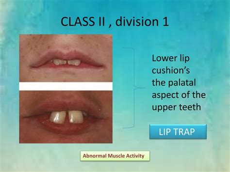 Angles Classification Of Malocclusion Ppt