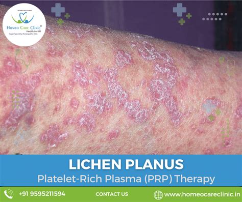 Lichen Planus Lesions