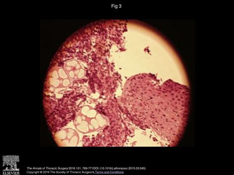 Esophageal Intramural Diverticula Multiple And Single Ppt Download