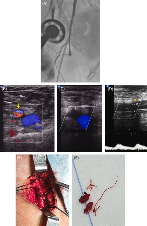 Vascular Access Complications Thoracic Key