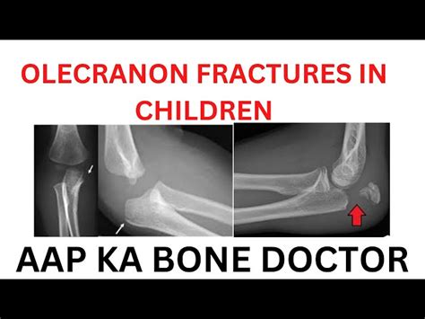 Olecranon Fractures