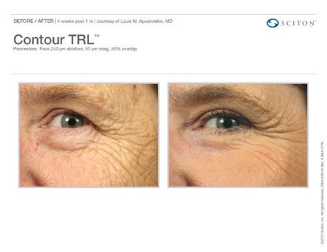 Contour Trl In Florence Ky Laser Face Contouring