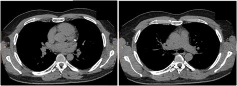 Chest Computed Tomography 17 May Download Scientific Diagram