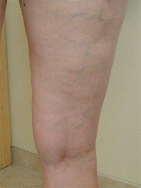 Spider Vein Before And After Photos Vein Center Orland Park
