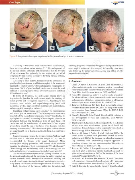 Giant Basal Cell Carcinoma Of The Scalp Rotation Advancement Flap As A