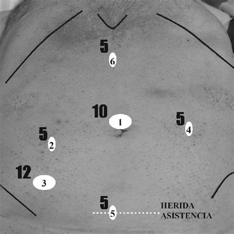 Pdf Restorative Proctocolectomy With An Ileoanal Pouch The Role Of Laparoscopy