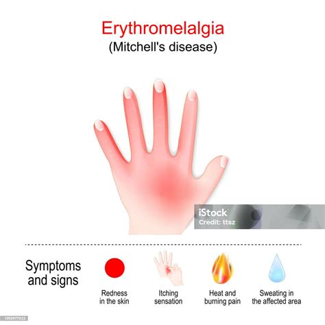Erythromelalgia Mitchells Disease In Left Hand Symptoms And Signs Of