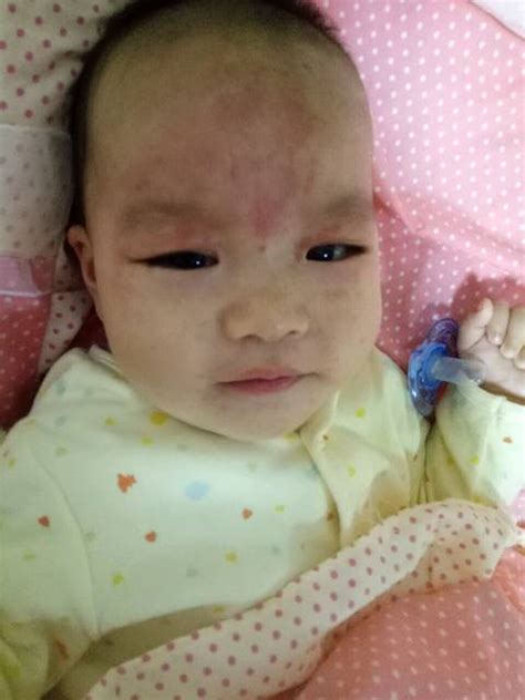 过敏性红疹吃什么药右侧脖子胳膊手偶有过敏性红疹 随意云