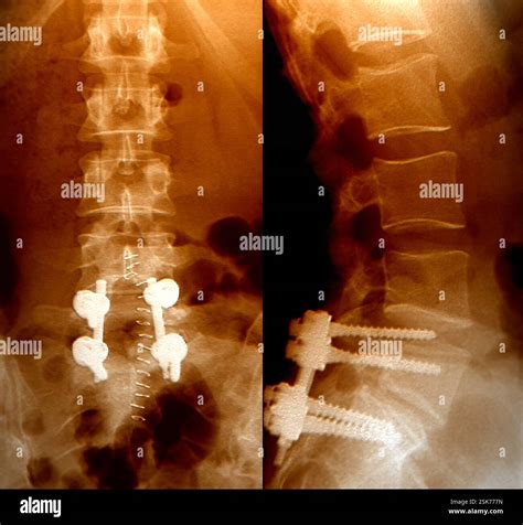 Treatment Of Spinal Displacement Frontal Left And Profile Right X
