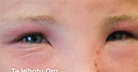 Phytophotodermatitis Image Phytophotodermatitis Image