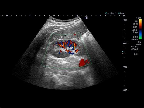 Abdomen Aplio A Series Clinical Gallery Ultrasound Canon Medical