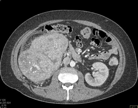 Clear Cell Renal Cell Carcinoma Rcc Invades Right Renal Vein And