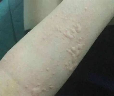 慢性荨麻疹反反复复怎么办【广州肤康】 哔哩哔哩