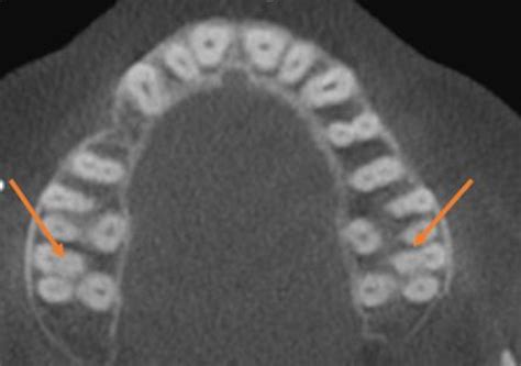 Presence Of Mb2 Canals In Maxillary Second Molar Teeth Download Scientific Diagram