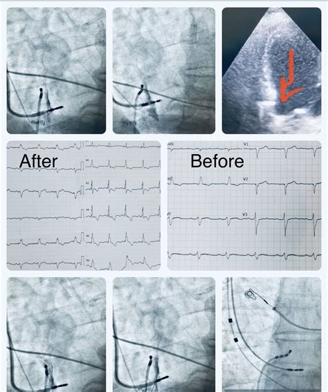 Dr Mohammed Magdy On Linkedin Below The Beauty Of Left Bundle Branch