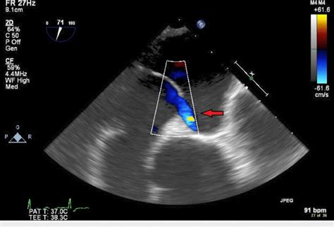 Tee Image Of Pfo Demonstrated By Color Doppler Revealing Right To Left