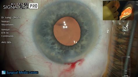 A Step By Step Phacoemulsification Procedure With Dr Eva Liang Eyetube