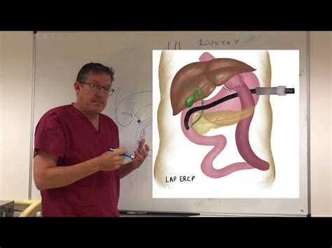 Roux En Y Choledochojejunostomy