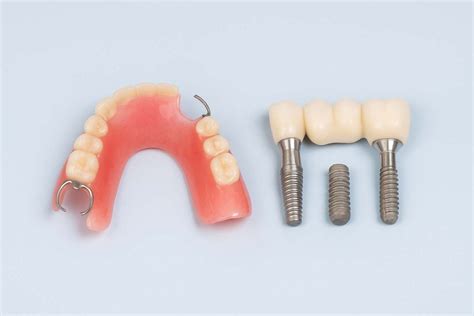 Dental Implants Or Partial Denture When To Choose Which Solution Lavin Dental Clinic