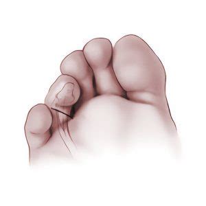 Curly Toes Cllc Montreal Dr Marie Gdalevitch