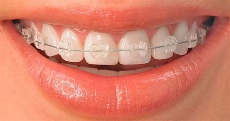 Brackets estéticos en Tacna Precios tipos y ventajas
