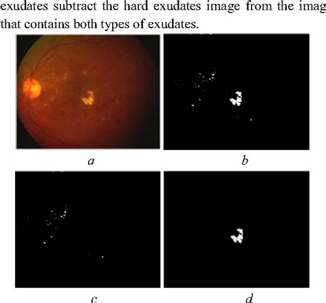 Figure 7 From Detection And Classification Of Exudates Using K Means Clustering In Color Retinal