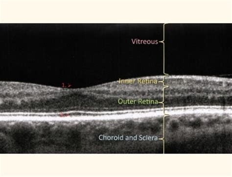 Oct Retina Examination Without Injection