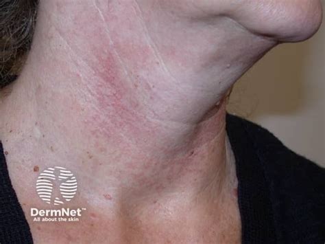 Poikiloderma Of Civatte