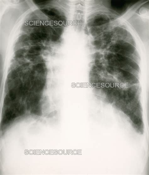 Farmers Lung Cxr