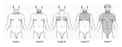 Classification Of The Severity Of Subcutaneous Emphysema Download Scientific Diagram