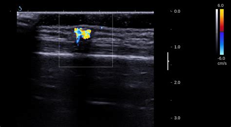 Vietnamese Medic Ultrasound Case 417 Black Skin Tumor Dr Phan Thanh