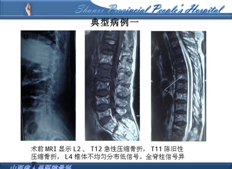 透彻解析骨质疏松椎体压缩性骨折的治疗策略 好医术早读文章 好医术 赋能医生守护生命