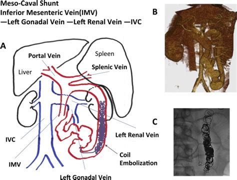Splenorenal Shunt Embolization
