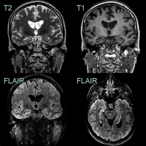Mesial Temporal Sclerosis Neuroradiology