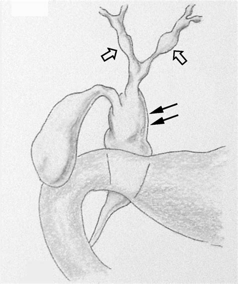 Congenital Anomalies And Normal Variants Of The Pancreaticobiliary