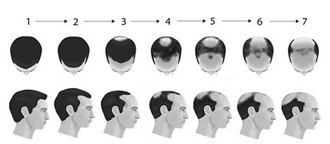 Hair Loss And Restoration Solutions — Ici Paris Skin Clinic Spa