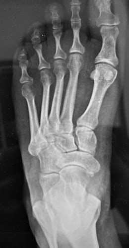 Imaging Pes Planus Vs Pes Cavus Flashcards Quizlet