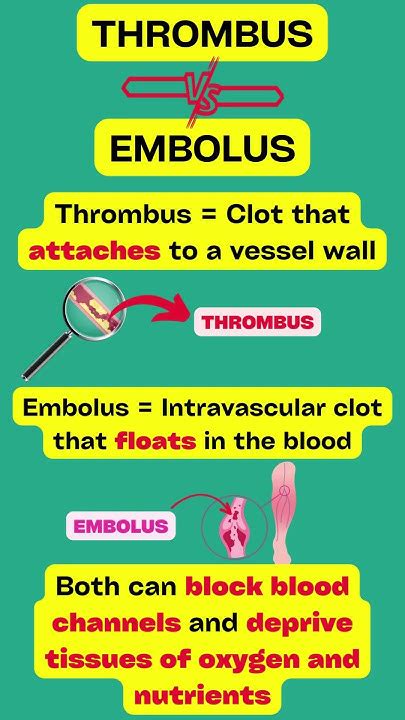 Thrombus Vs Embolus Explained Youtube