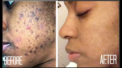 How To Get Rid Of Hyperpigmentation With Lemon Juice Nano Tech For Skin