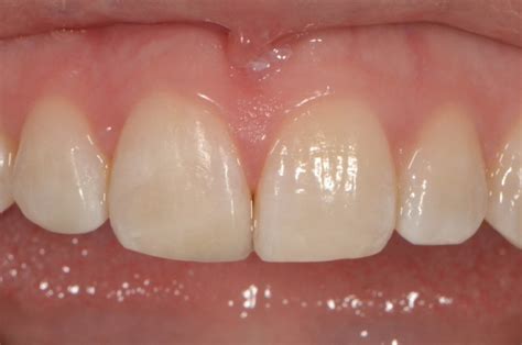 Simple Process For Making Beautiful Anterior Composites Spear Education
