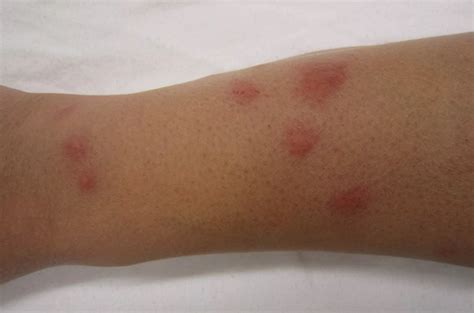 Gigitan Kecoa Ciri Ciri Akibat Dan Cara Menanganinya