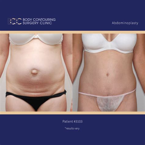 How To Tell If Your Abdominal Muscles Were Torn During Pregnancy