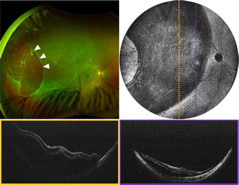 Rhegmatogenous Retinal Detachment Oct