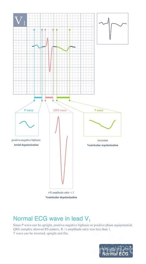 Normal Ecg Wave In Lead V1 Photograph By Science Photo Library Pixels