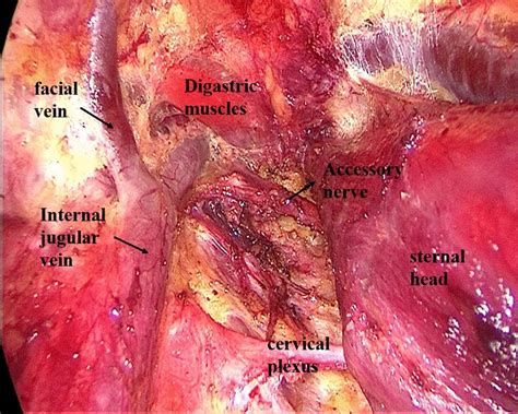 Exposure Of Accessory Nerve And Dissection Of Lymph Nodes At Level Ii A
