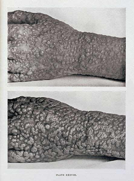 Progression Of The Smallpox Rash · History Of The Smallpox Vaccine · Iu