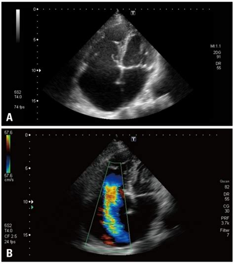 A Two Dimensional Echocardiography Recorded In The Patient With