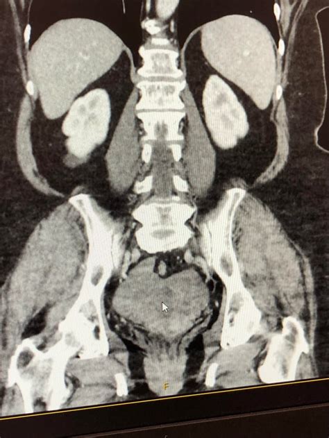 Sex Life R Hysterectomy