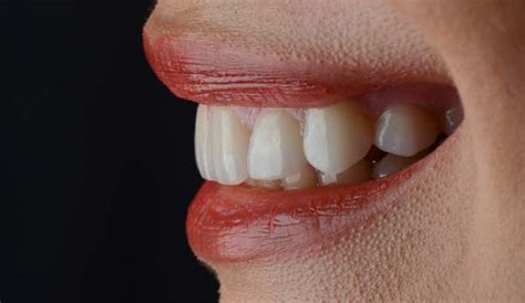 A Smile Makeover Can Improve Discolored Teeth Perfect Choice Dental P